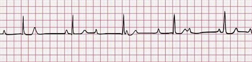 Heart Blocks First Second And Third Degree Deranged Physiology